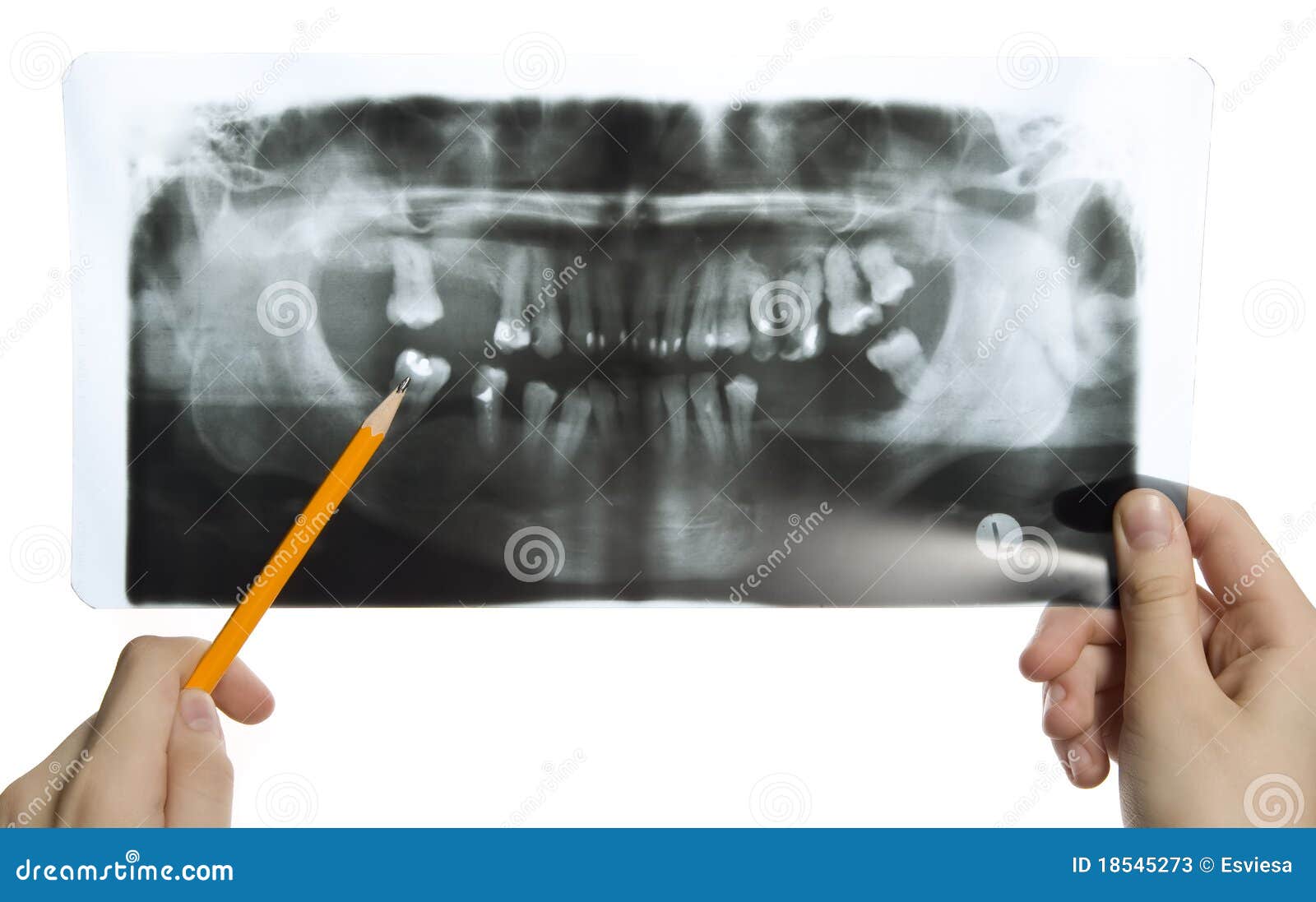 Roentgen photo of teeth stock image. Image of teeth, dentist - 18545273