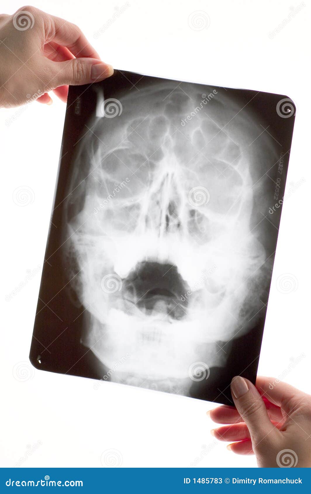 Roentgenogram stock image. Image of hands, trepanation - 1485783