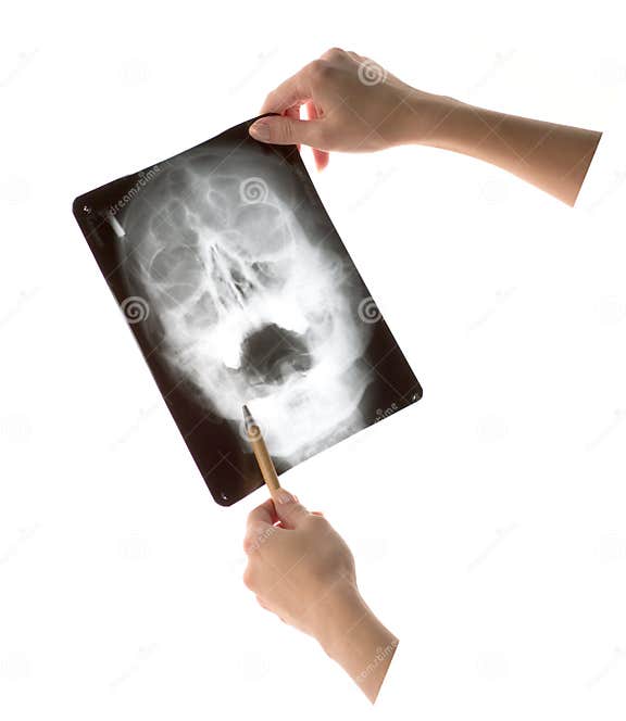 Roentgenogram stock photo. Image of health, xray, skeleton - 1485784