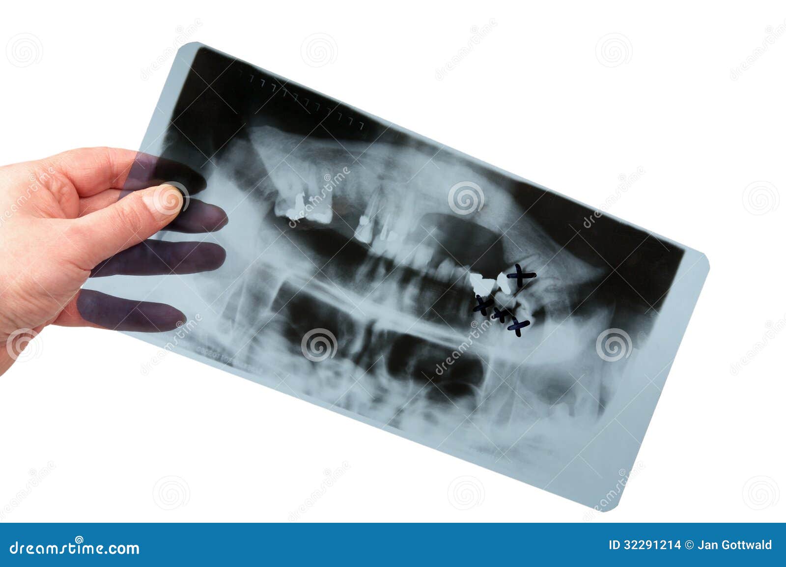 Roentgenogram stock photo. Image of isolated, surgeon - 32291214