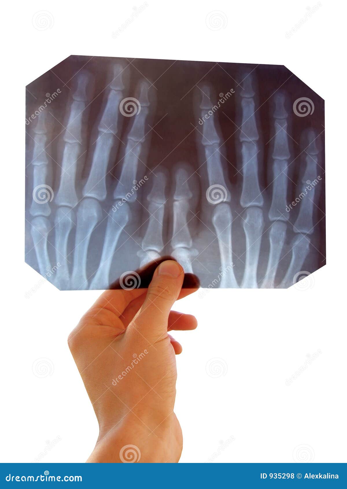Roentgenogram (X-ray) stock photo. Image of medicine, phalanx - 935298