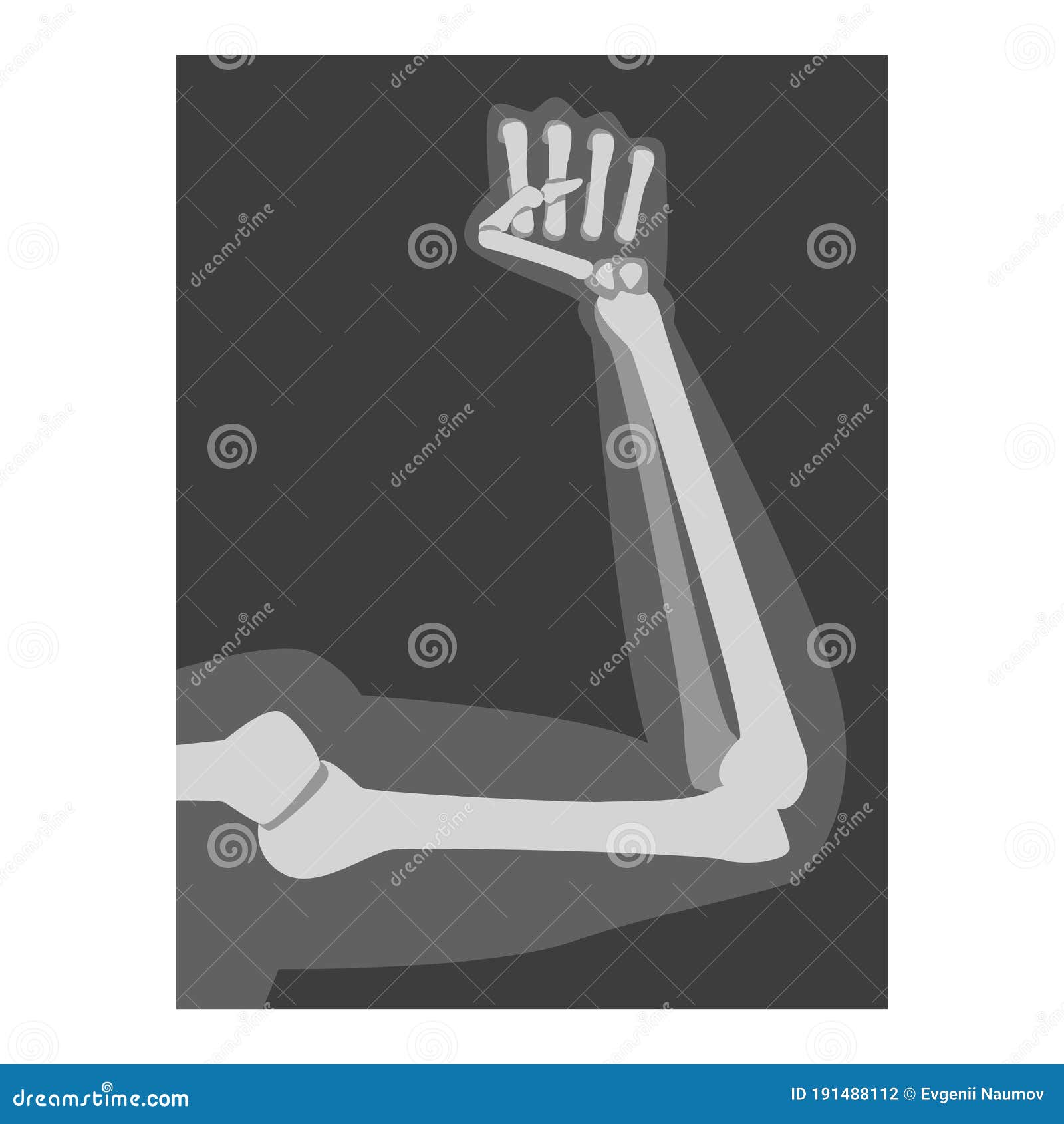 Roentgenograph Of Forearm Front View Vector Image | CartoonDealer.com ...