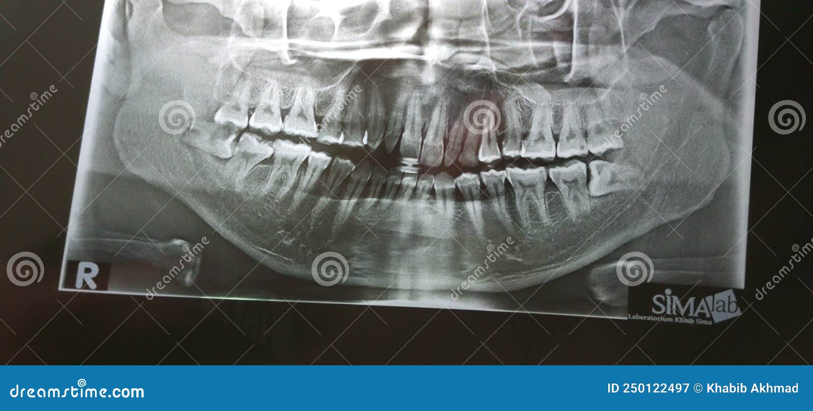 Rongent Photo of Wisdom Teeth Stock Image - Image of statue, glass ...