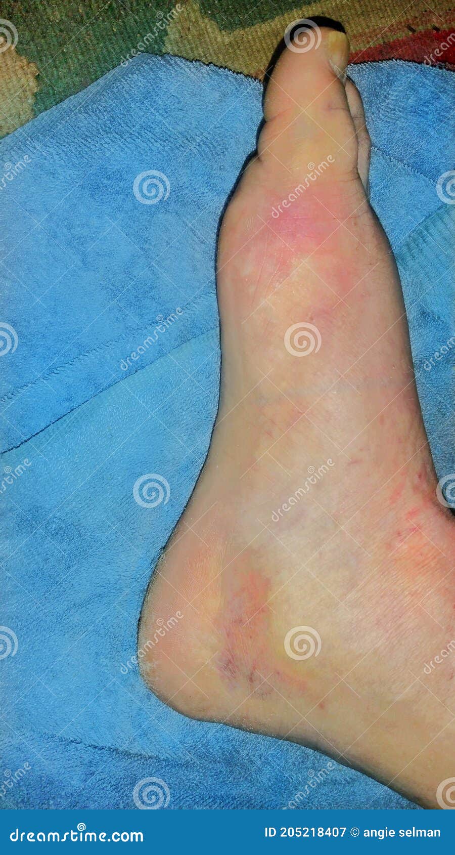 Rood En Gezwollen Voet Gekneusd Stock Afbeelding Image Of Been Lidmaat 205218407