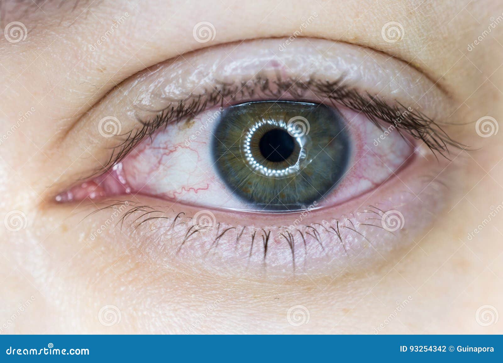 Rood Geïrriteerd Menselijk Oog Stock Foto - Image of ...