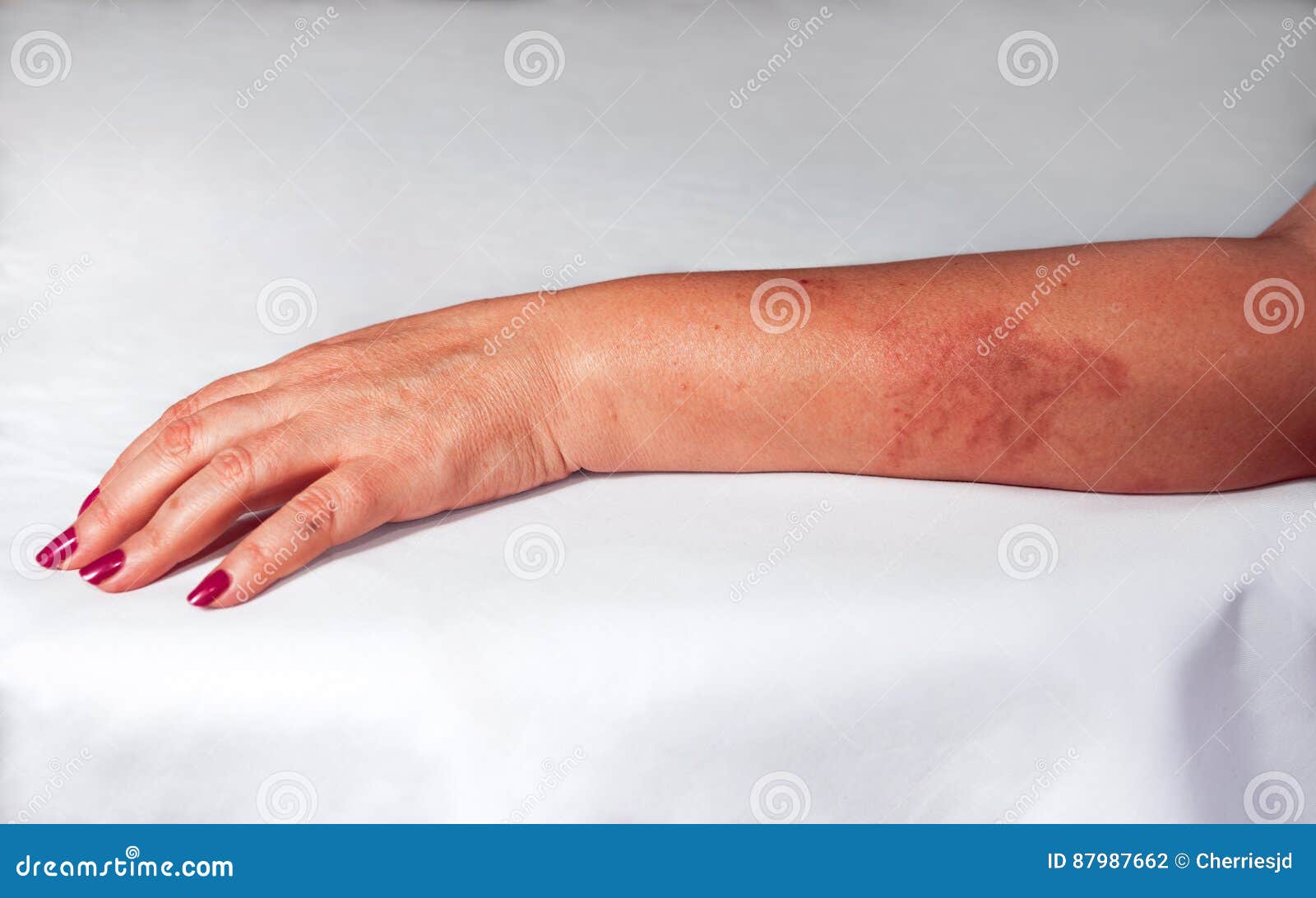 Roodheid Van Brandwond Op Vrouwenhand Stock Foto - Image of zorg, hulp ...