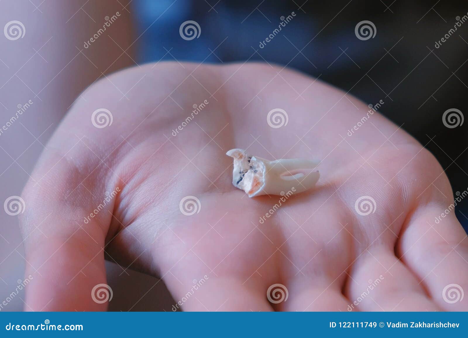 Root of the Big Tooth in the Woman`s Hands. Stock Image - Image of dent ...
