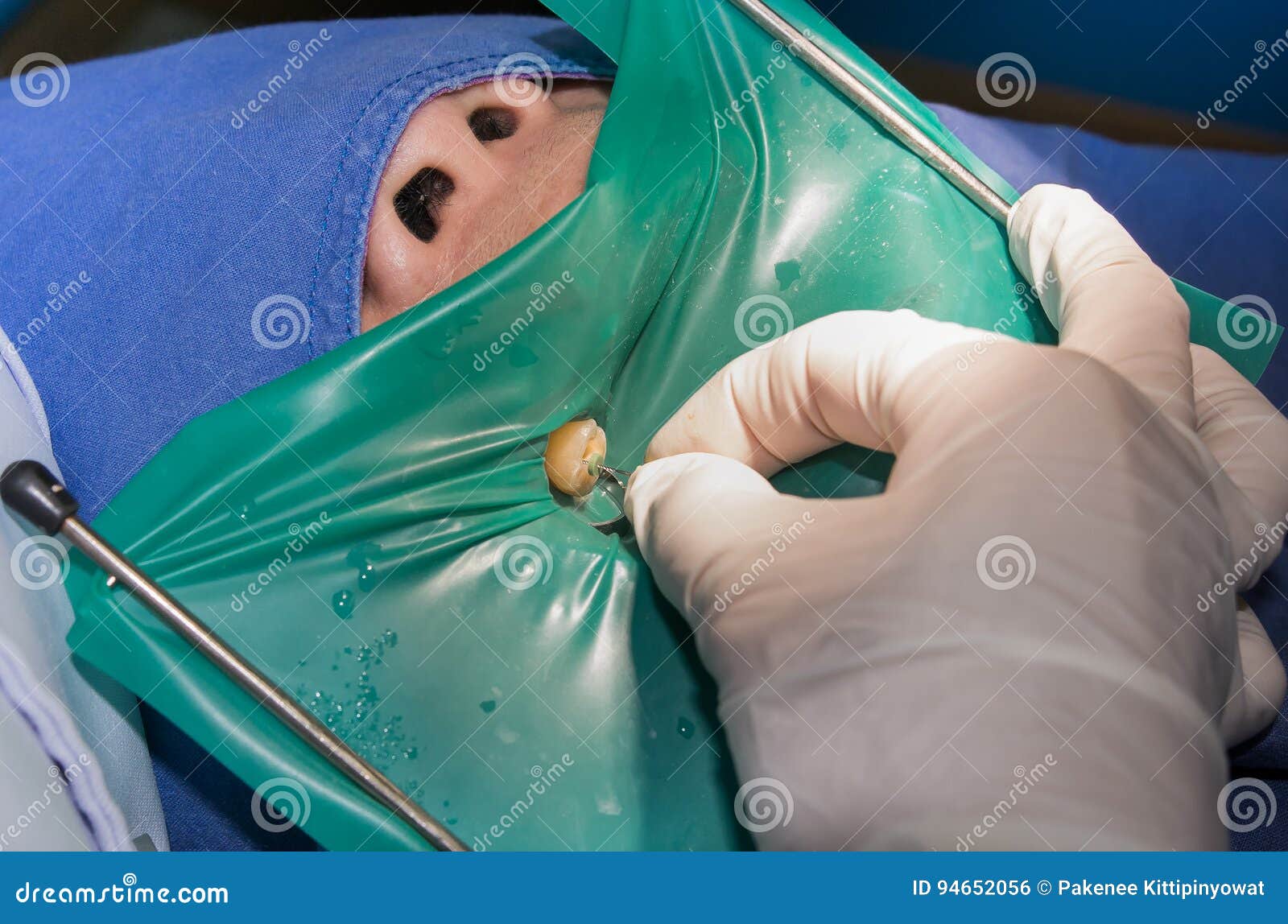 Root Canal or Endodontic Surgery Stock Photo - Image of infectious ...