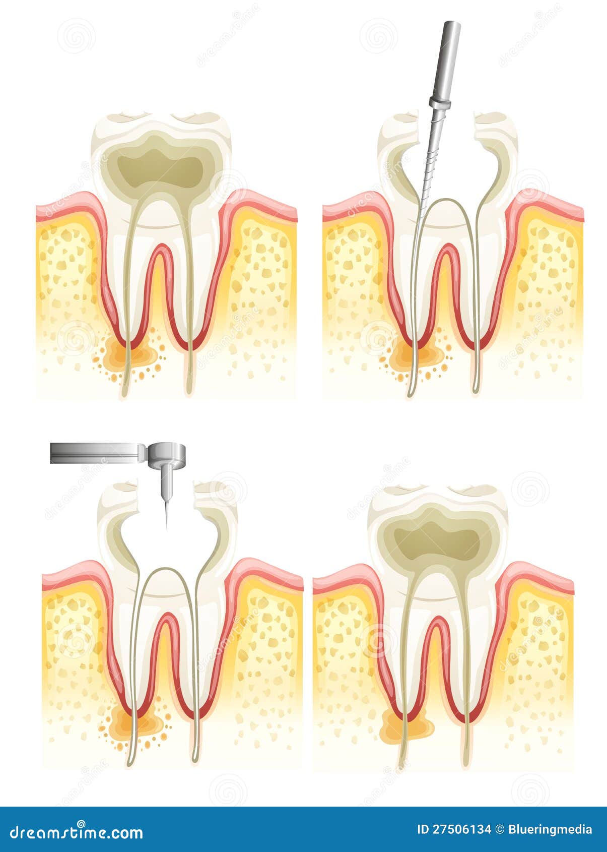 Root canal process stock illustration. Illustration of anatomy - 27506134