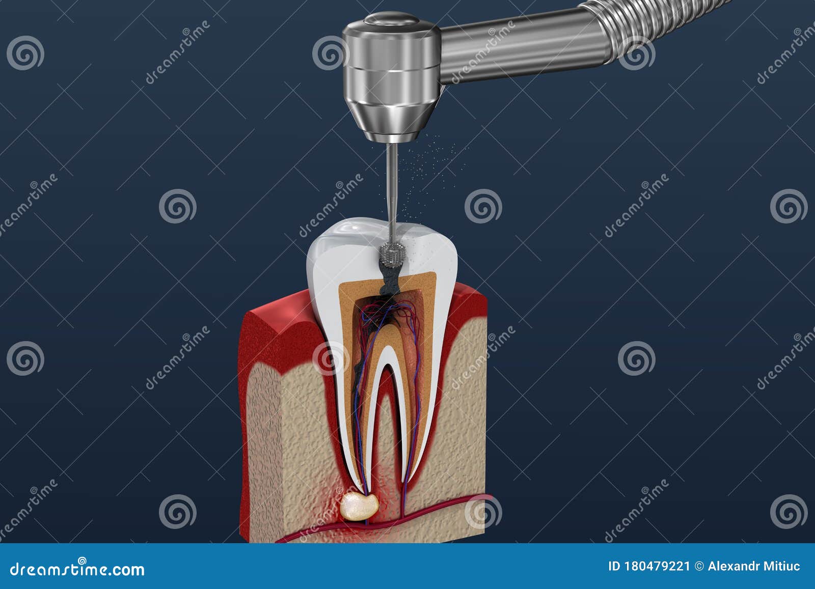 Root Canal Treatment Process. Illustration Stock Illustration ...