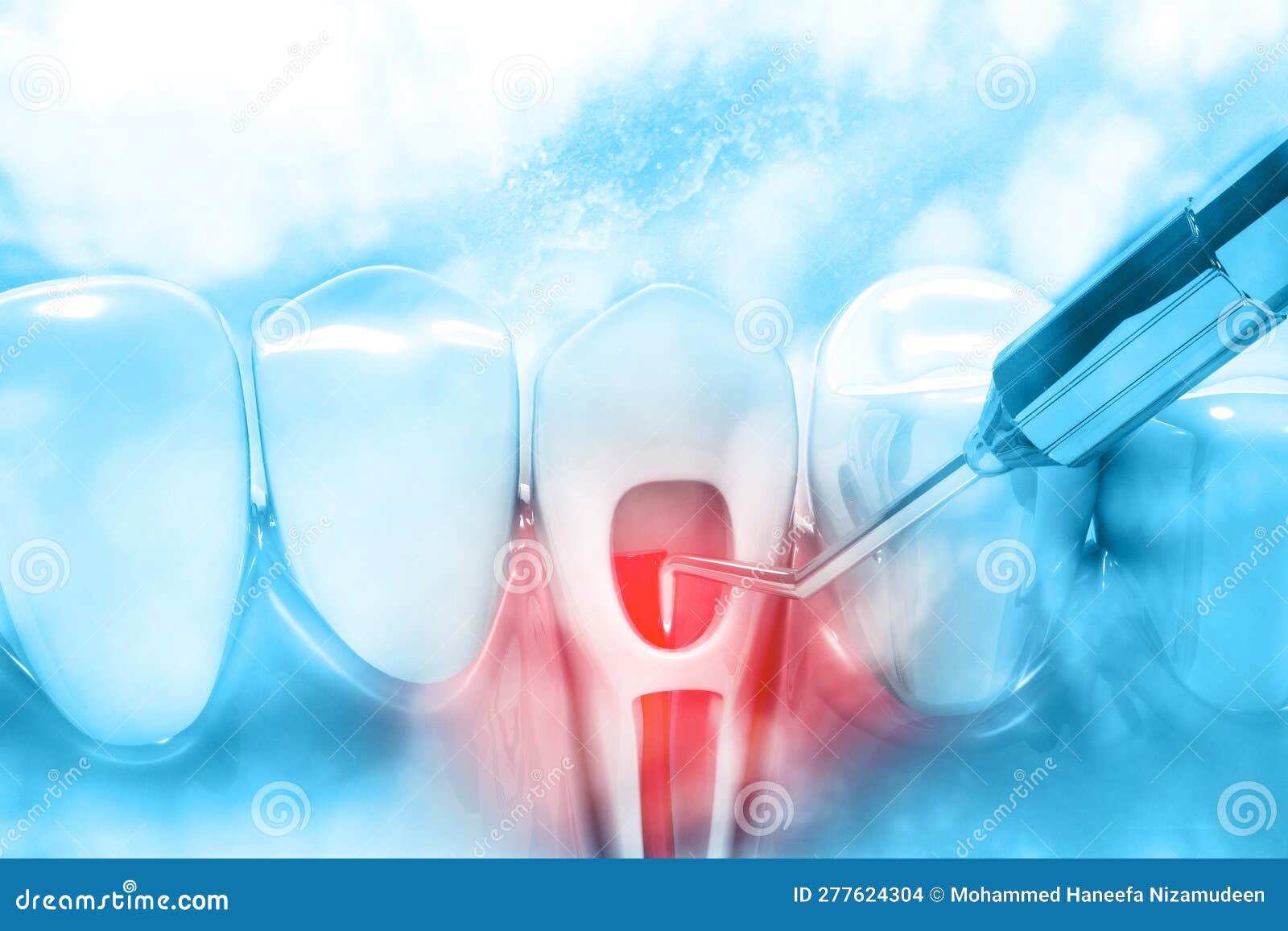 Root Canal Treatment Process Stock Illustration - Illustration of ...