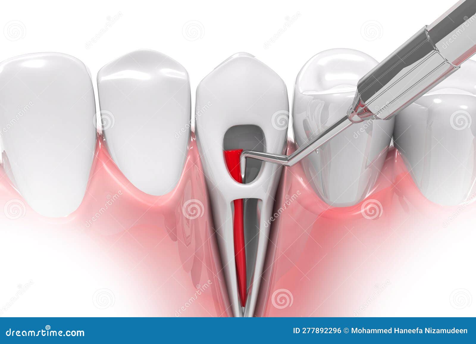 Root Canal Treatment Process Stock Illustration - Illustration of ...