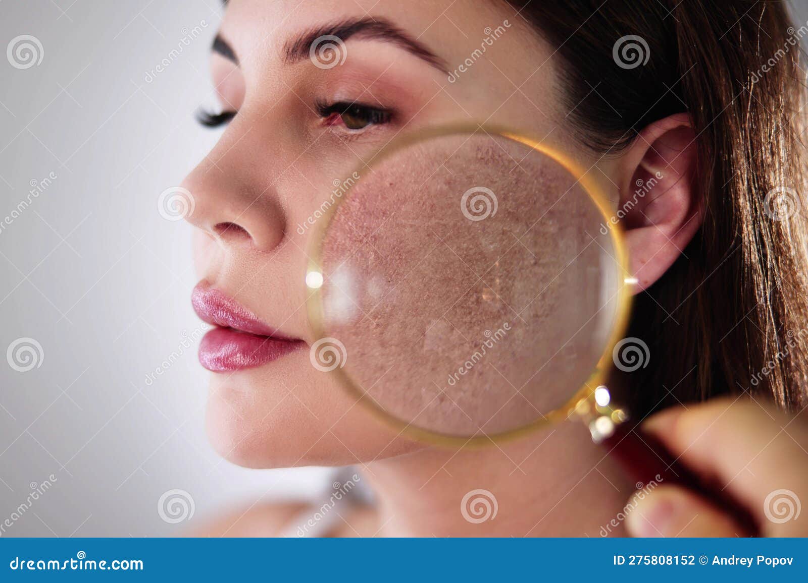 Rosacea Face. The Girl Suffers From Redness On Her Cheeks. Couperosis ...