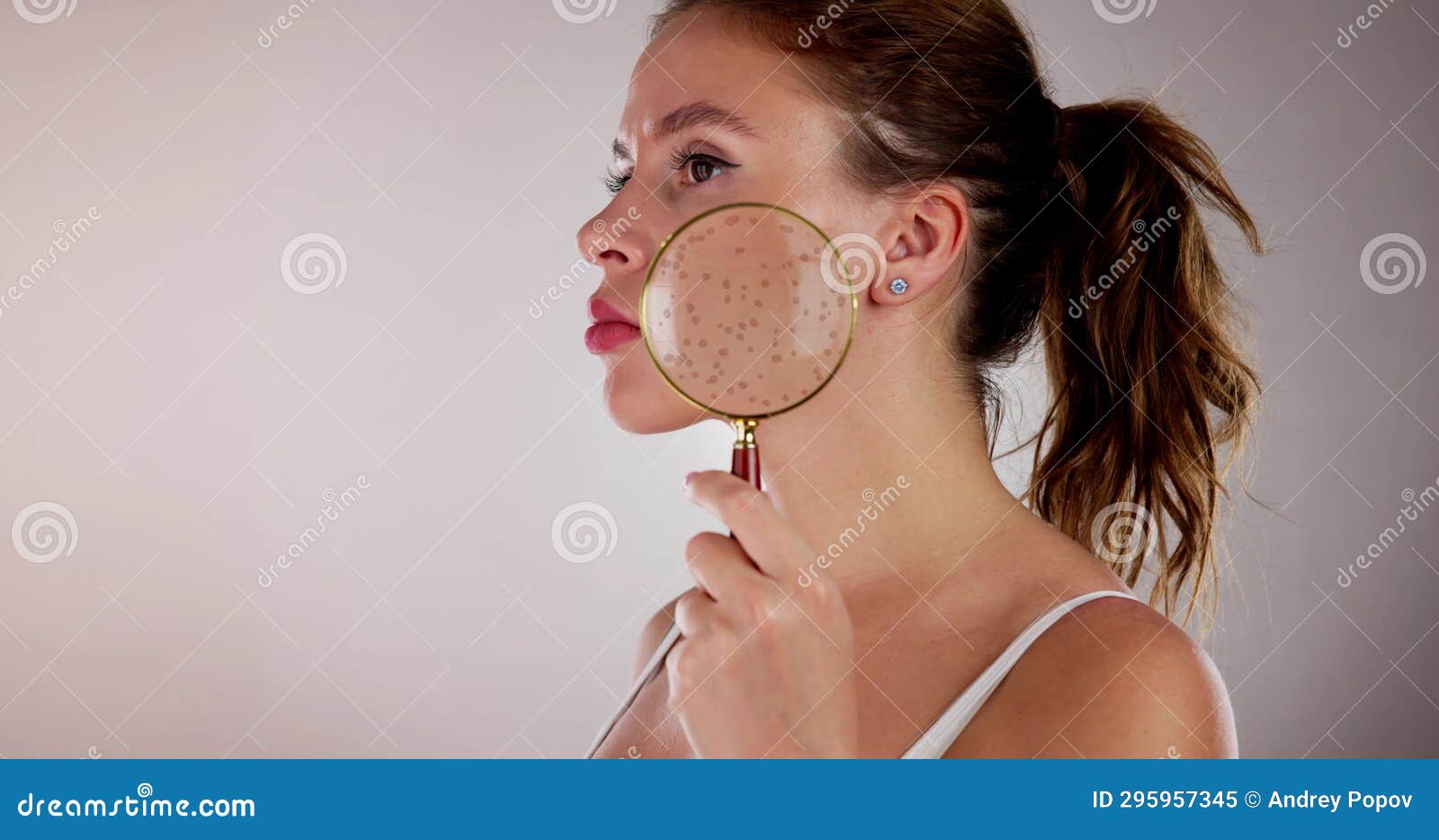 Rosacea Face. The Man Suffers From Redness On Her Cheeks. Couperose Of ...