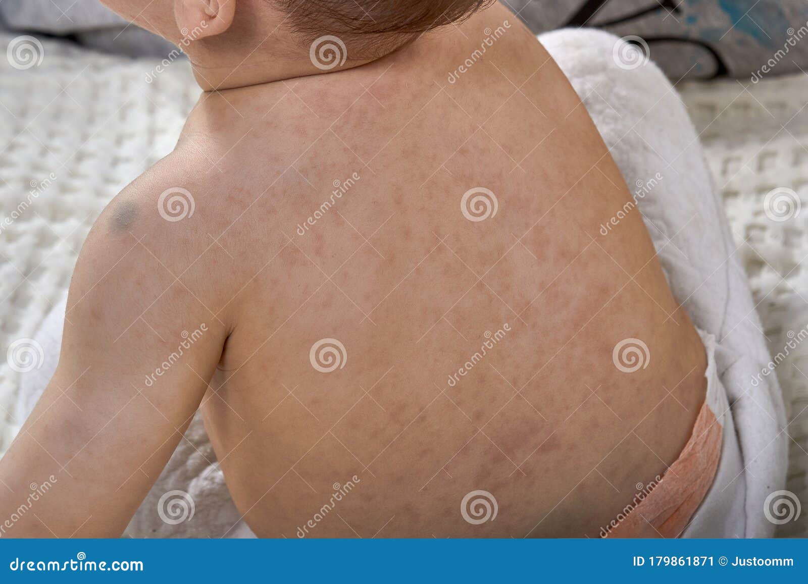 Roseola Rash A Viral Rash On The Skin Of A Child Stock Photography ...