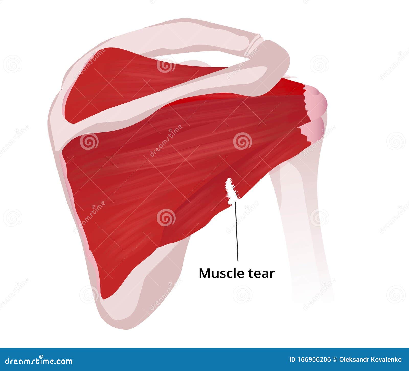 Rotator Cuff Tear. Illustration of the Rotator Cuff Muscle Anatomy ...