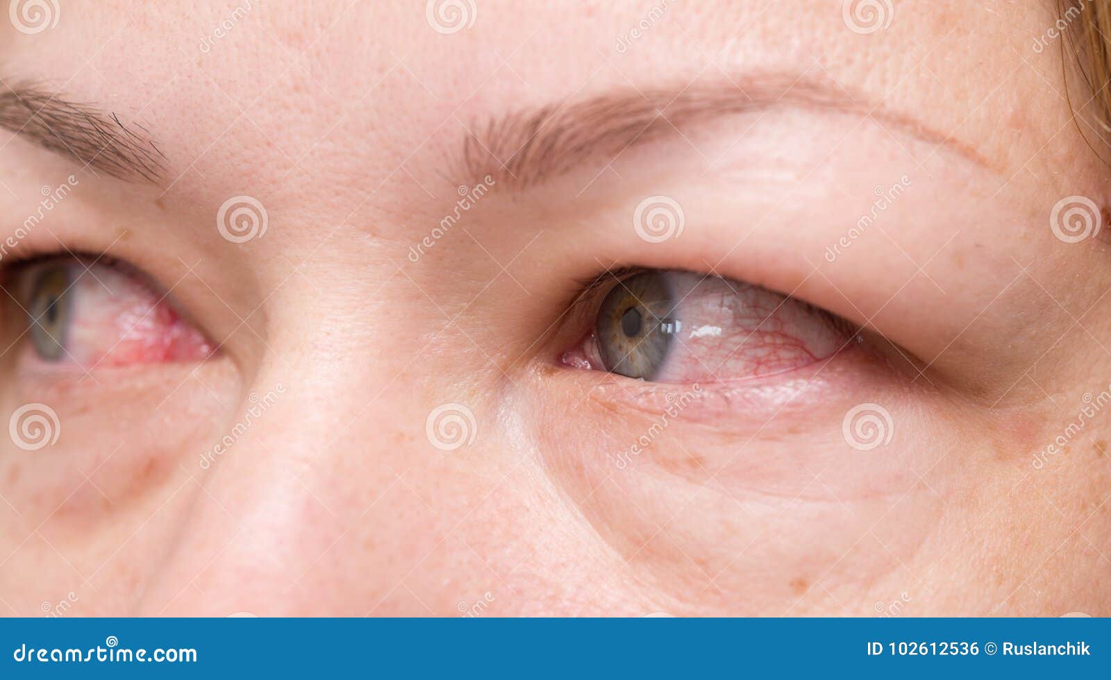 Rote Augen stockfoto. Bild von frau, allergie, blut - 102612536