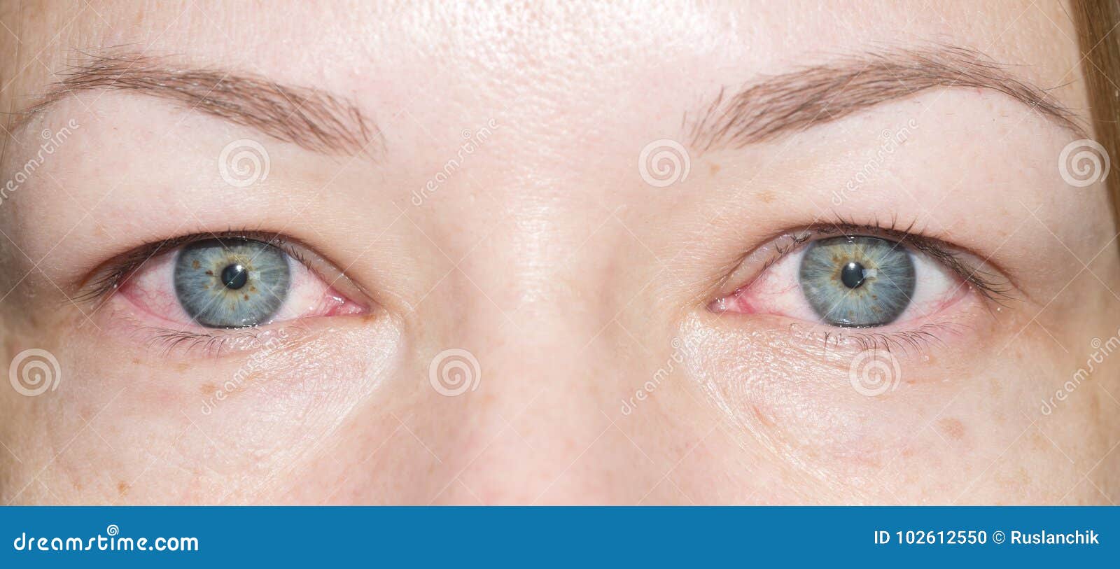 Rote Augen stockfoto. Bild von medizin, makro, blut - 102612550