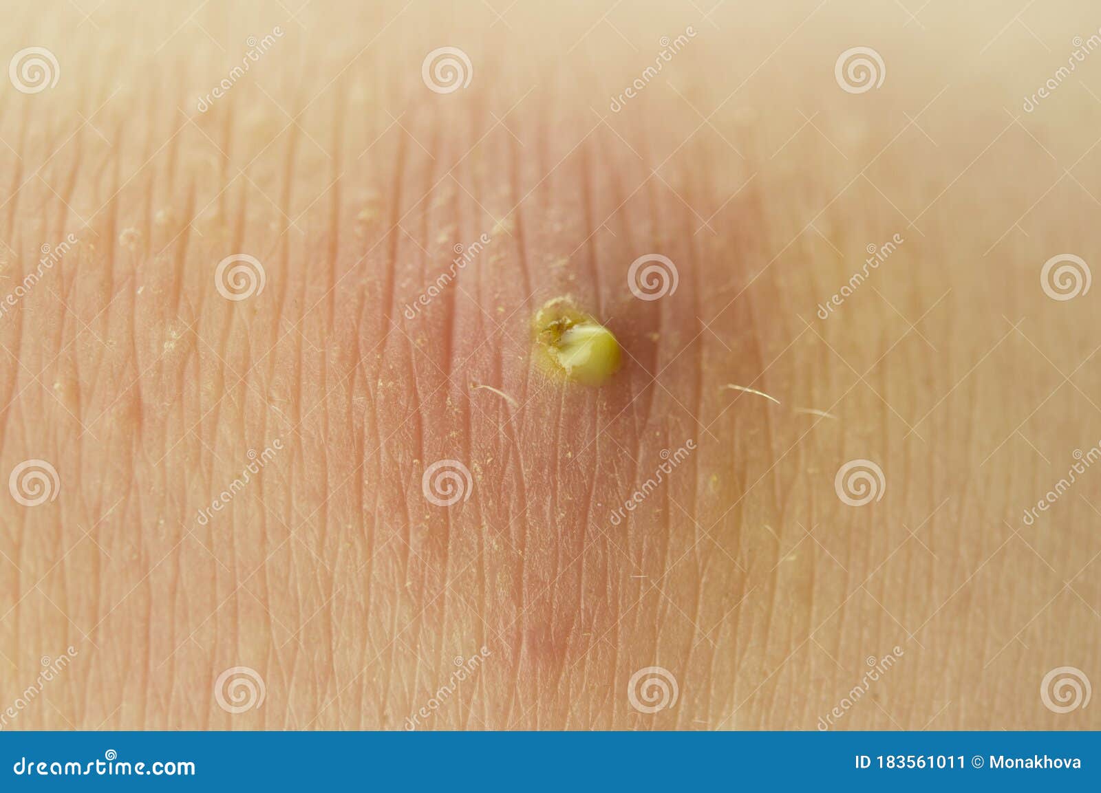 Roter Eitriger Pickel Auf Der Haut Stockbild - Bild von hygiene ...