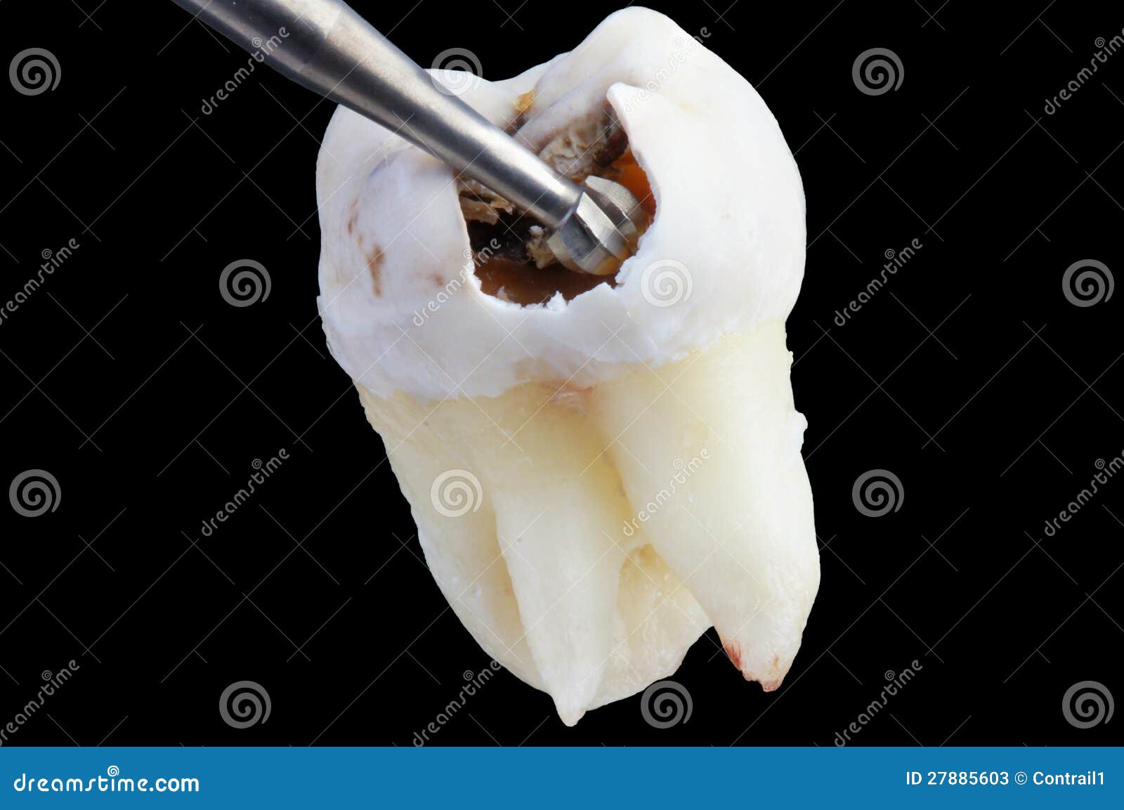 Rotte tand stock afbeelding. Image of verwijder, behandeling - 27885603