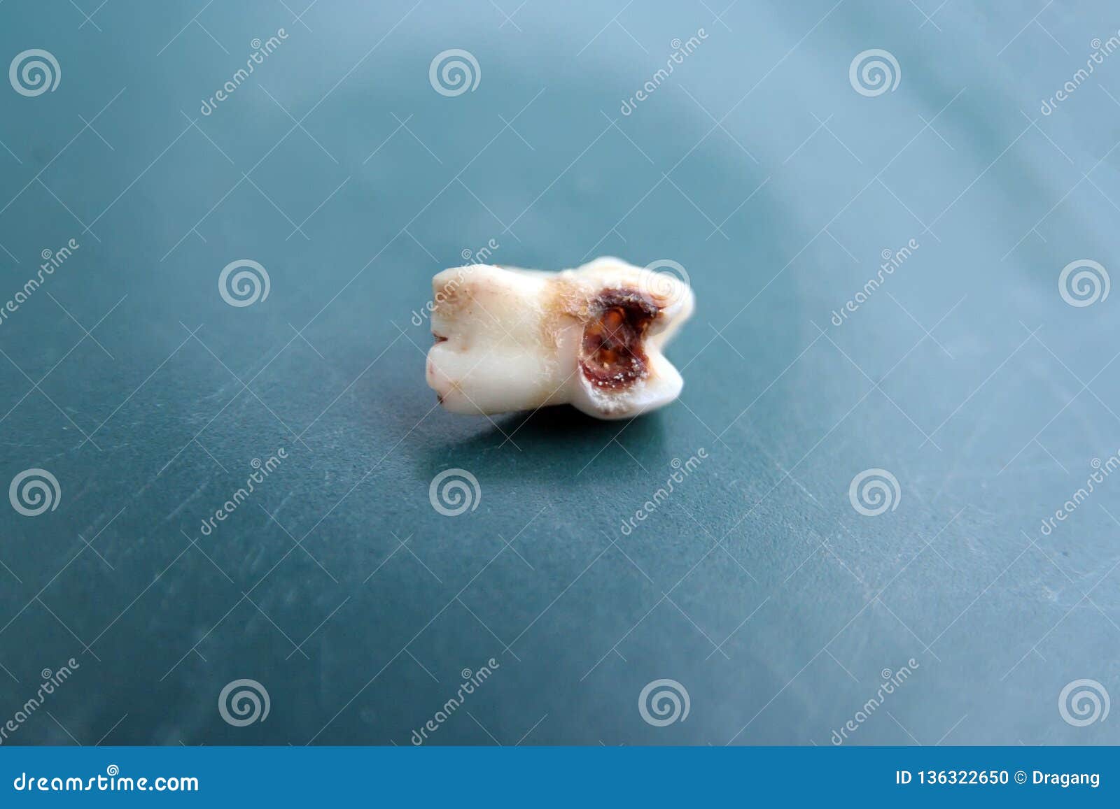 Rotten Tooth. Bad Tooth. Extracted Rotten Tooth Stock Photo - Image of ...
