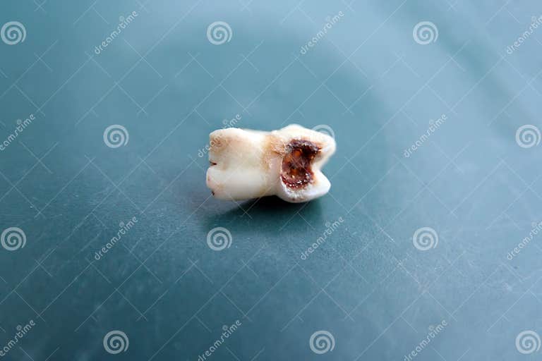 Rotten Tooth. Bad Tooth. Extracted Rotten Tooth Stock Photo - Image of ...