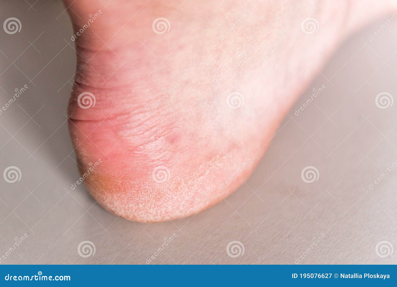 Rough Dry Skin On The Hand After Sunbathing, Tendon And Blue Vein Stock ...