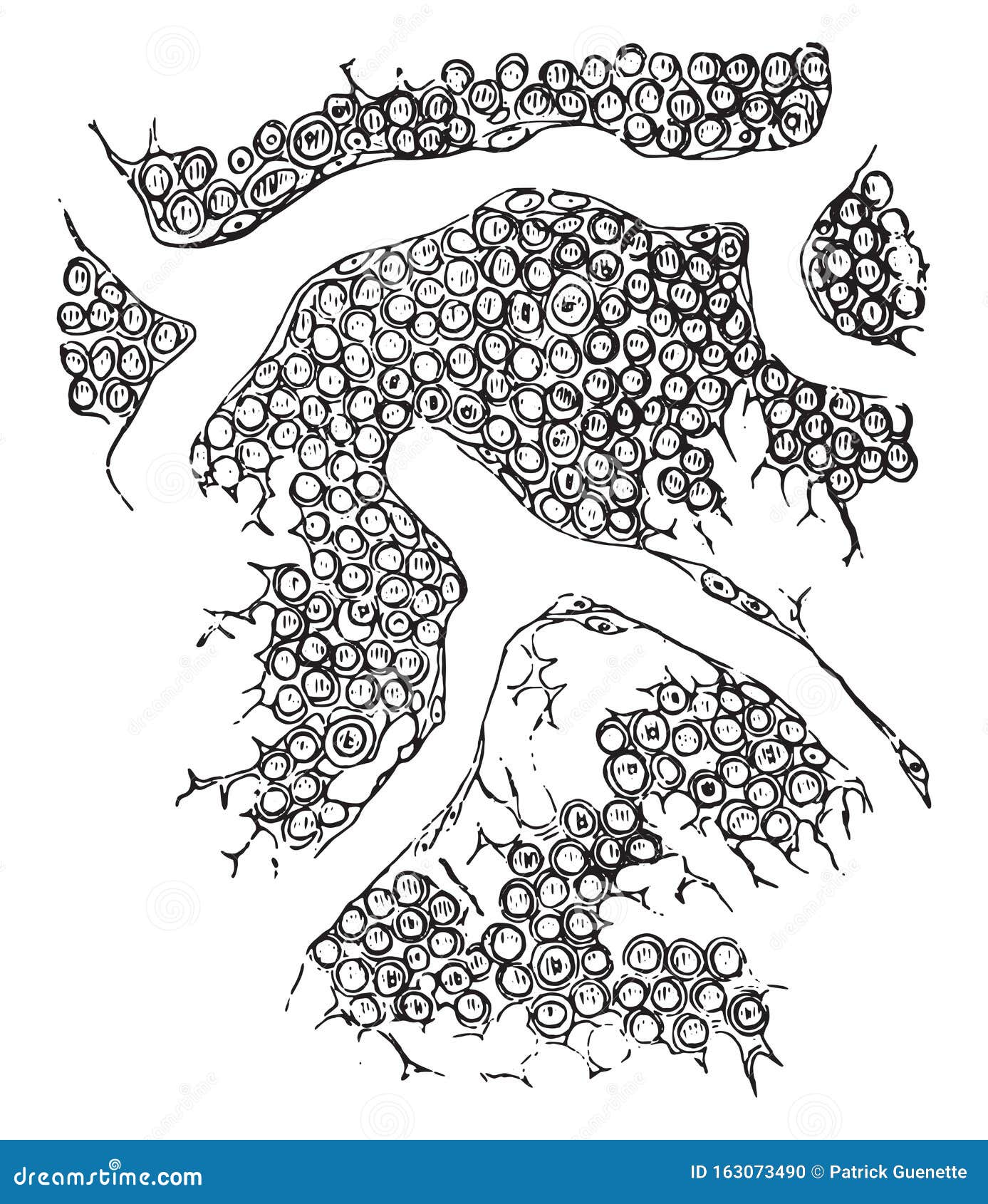 Round Cell Sarcoma, Vintage Engraving Stock Vector - Illustration of ...