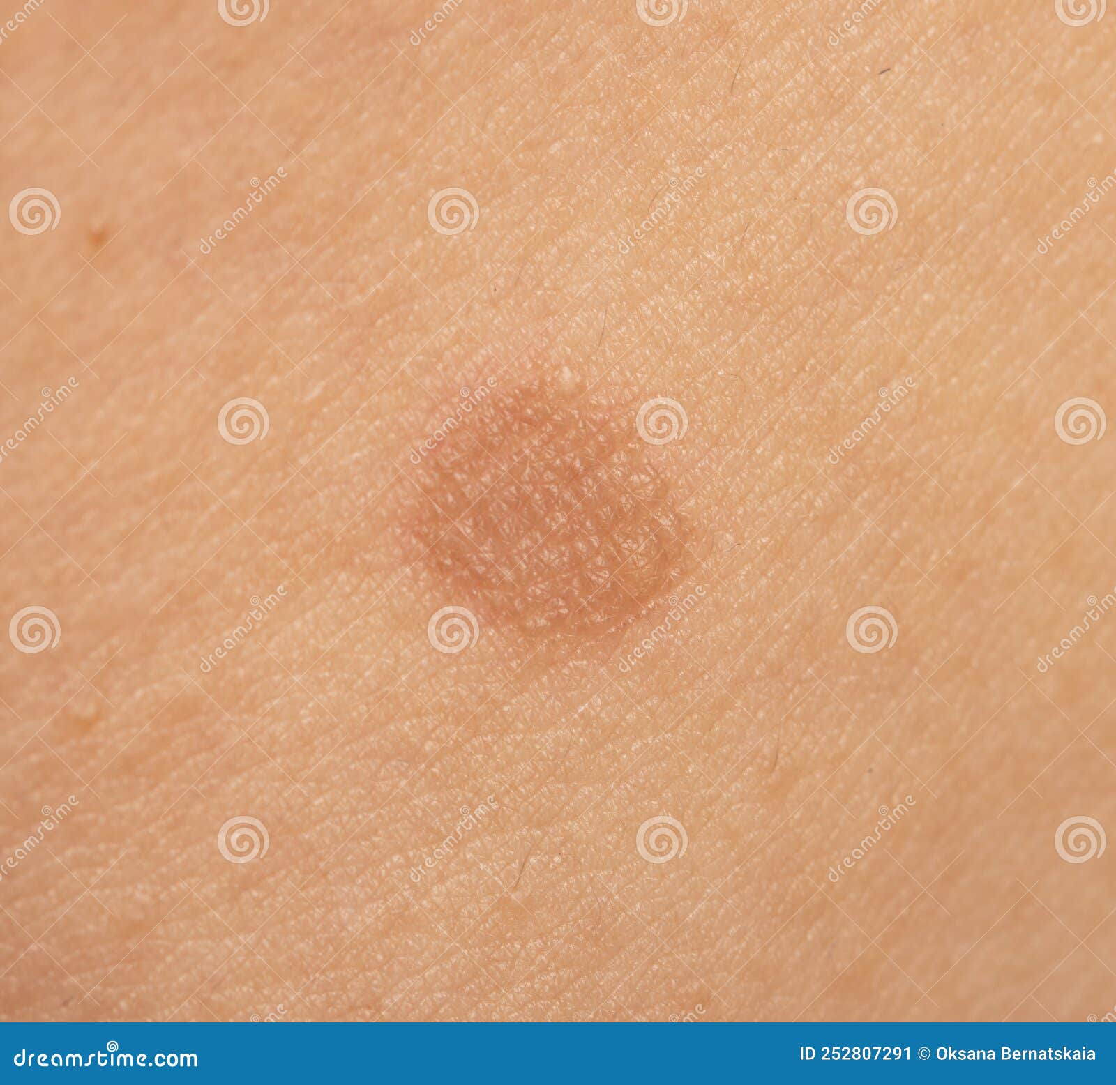 Round Skin Burns from Hot Oil Stock Image - Image of skin, female ...
