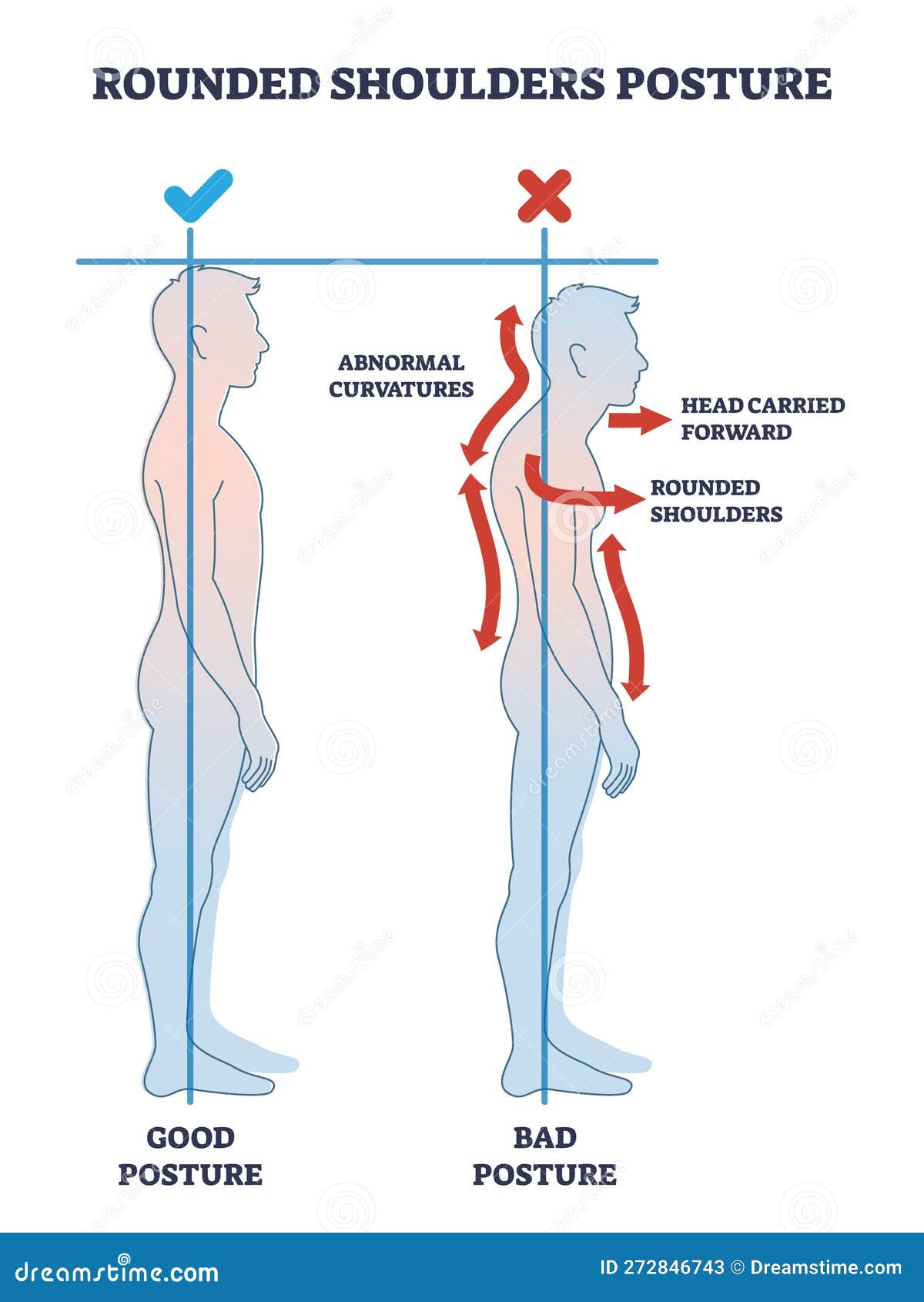 Rounded Shoulders Posture with Body Alignment Forward Outline Diagram ...
