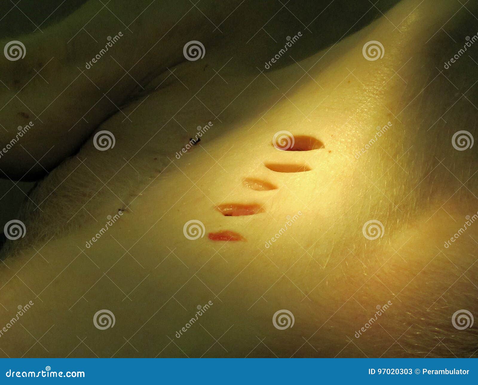 Surgical Incisions In The Abdomen After Laparoscopy For Cholecystectomy ...