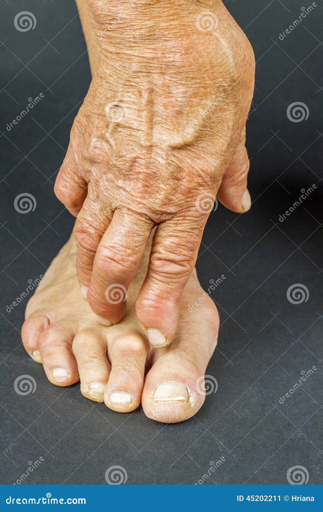 Rrheumatoid Arthritis Hand and Toe Deformities Stock Image - Image of ...