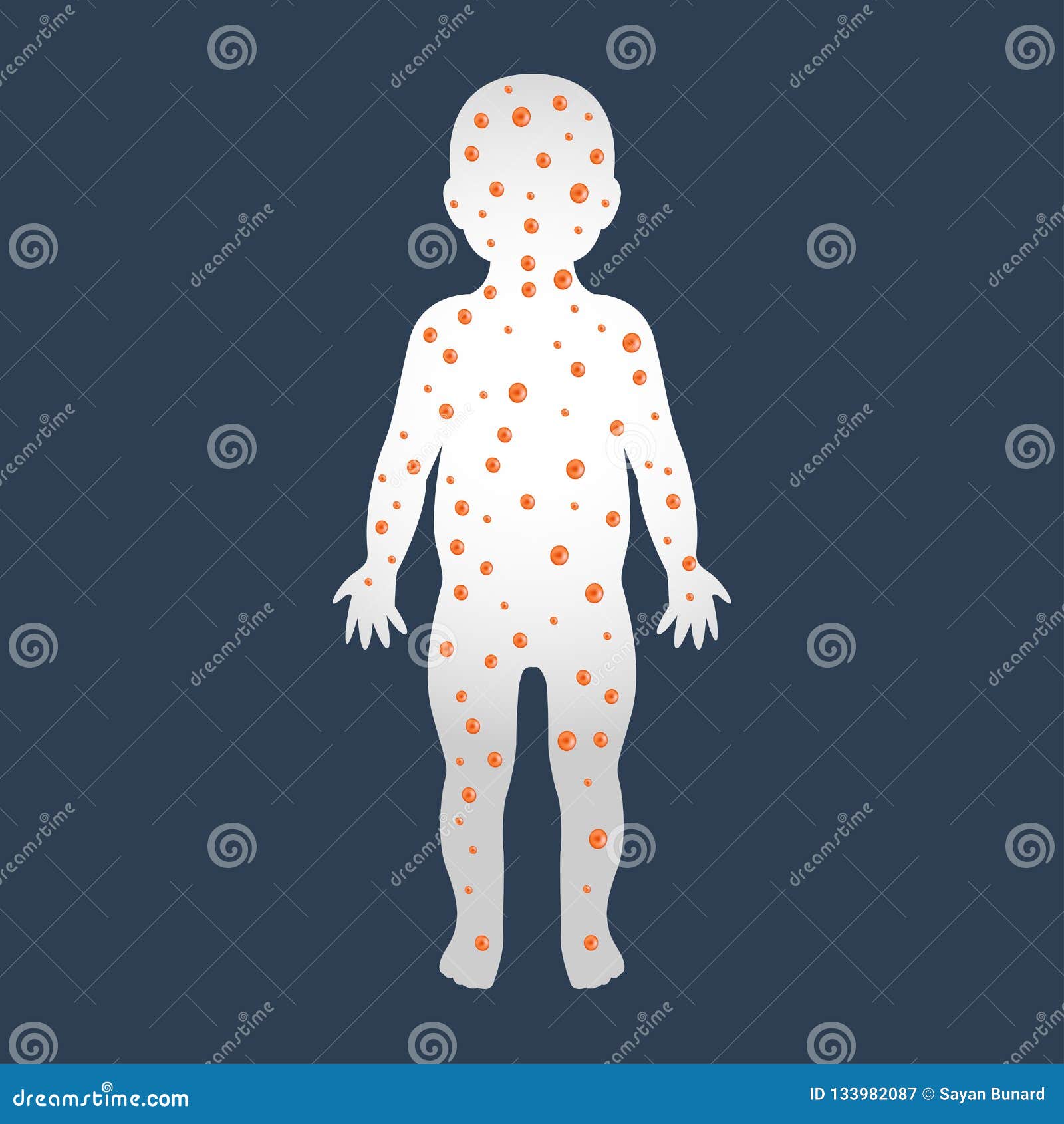 Rubella, German Measles. The Girl Sick Rubella. Prevention And Symptom ...