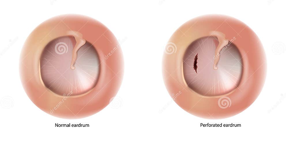 Ruptured Eardrum or Hole in the Eardrum. Perforated Eardrum and Normal ...
