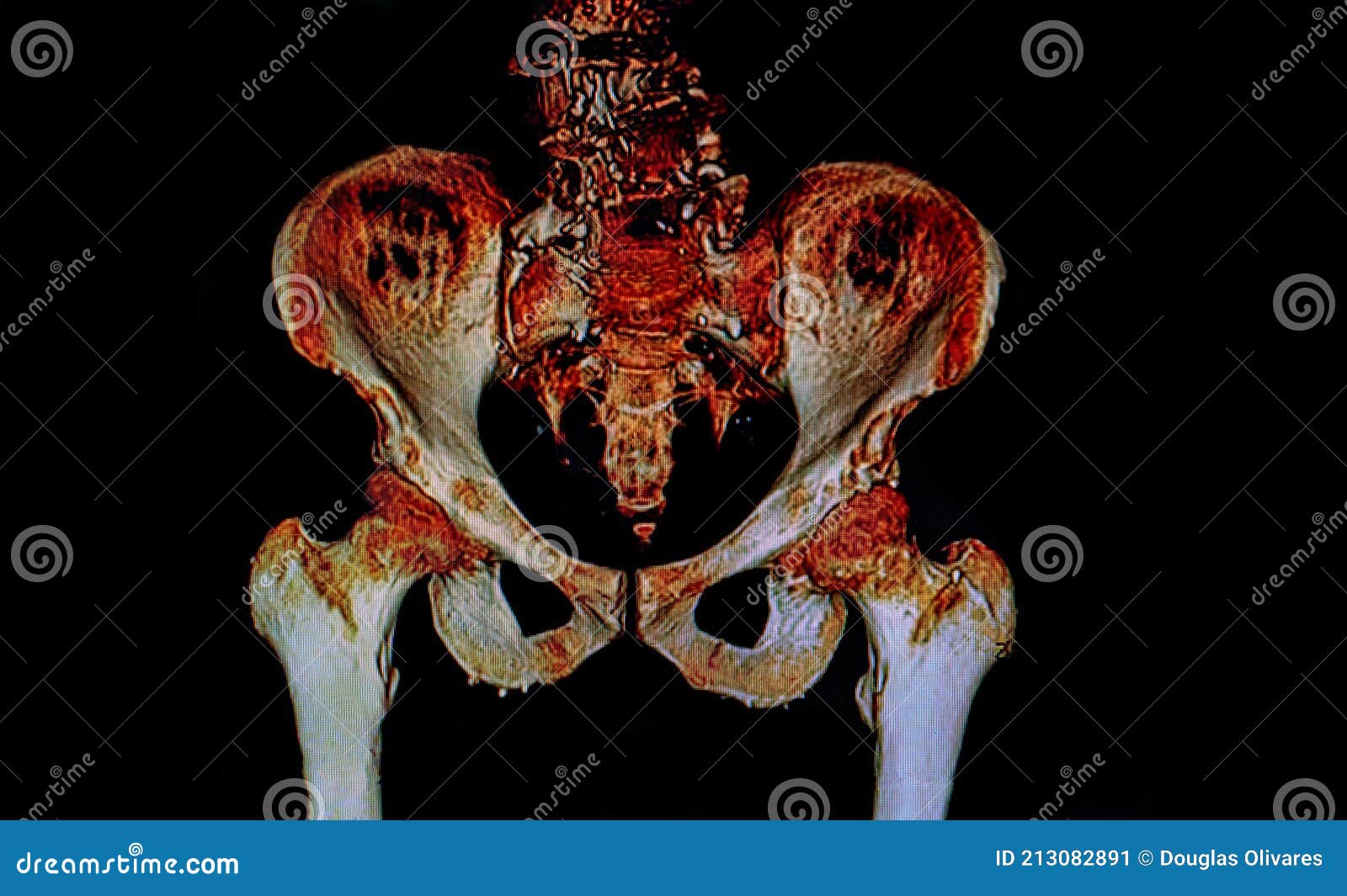 The Bones Of The Pelvis Of Homo Sapiens Modern Type Latin: Homo Sapi On ...