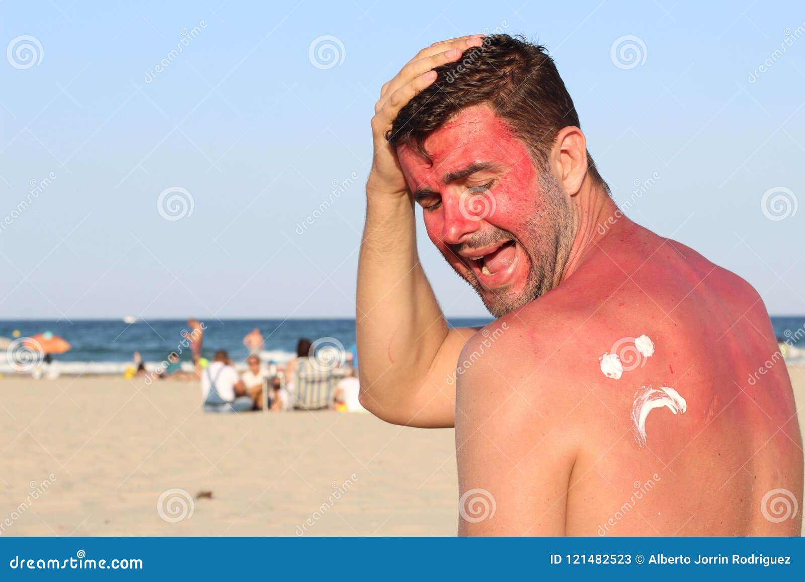 Sunburned Skin On Shoulder And Back Of A Woman Red Skin Sun Burn After