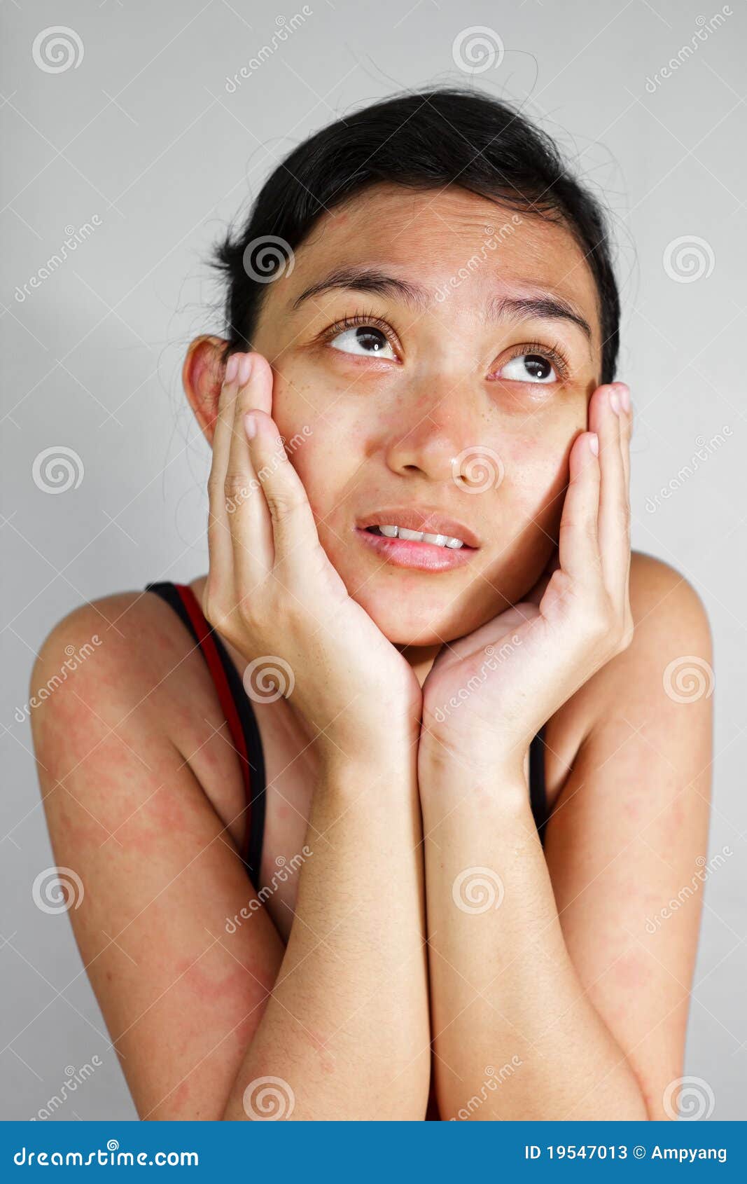 Sad woman with skin rash stock image. Image of health - 19547013