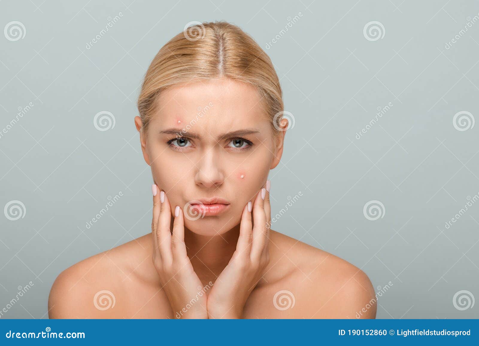 Sad Young Woman Touching Face with Acne Stock Photo - Image of acne ...