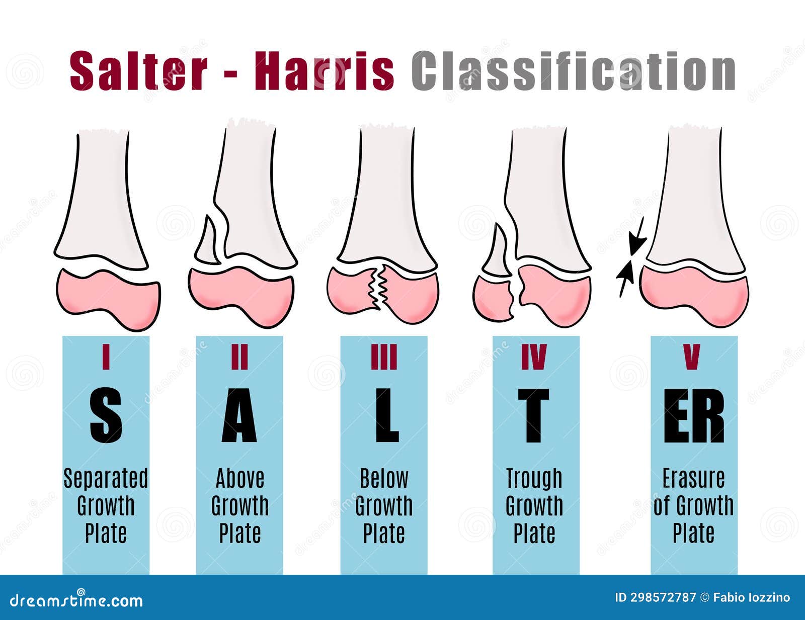 Clasificarea Lui Salter Harris în Vederea Recunoașterii și ...