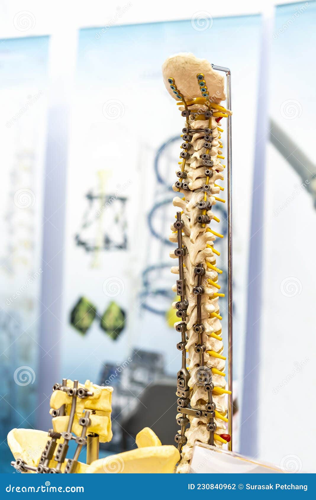 Sample Structure Show Spine Bone and Hip Bone with Metal Fixation Set ...