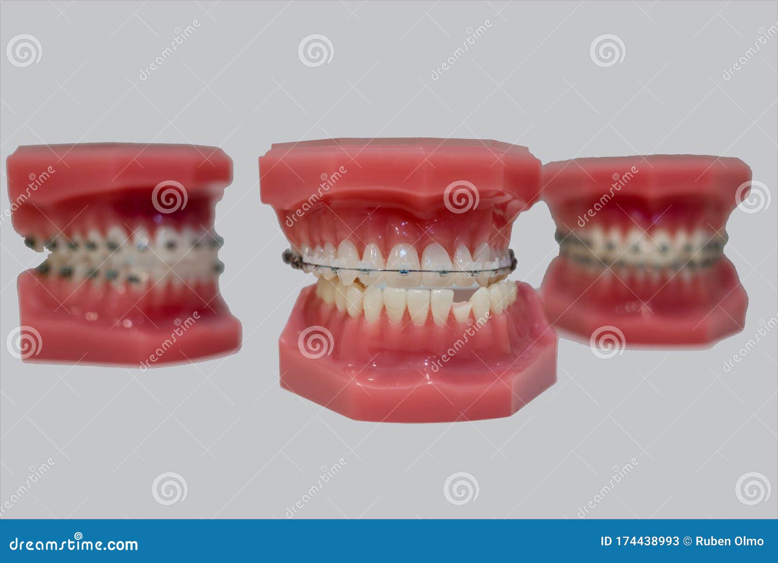 Samples of Dentures with Porcelain Teeth and Dental Device on a White ...
