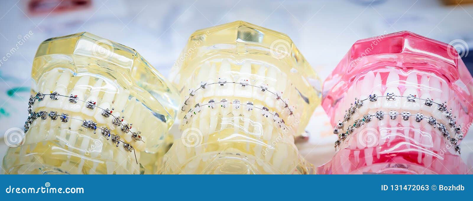 Orthodontic Braces on Model Stock Image - Image of invisible ...