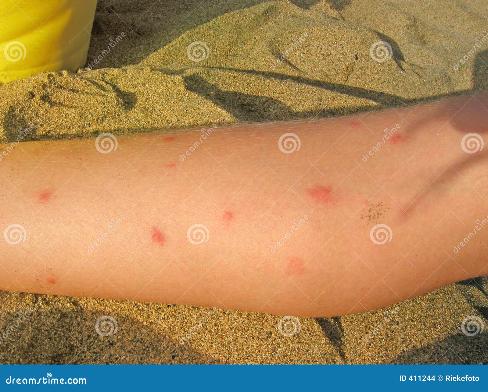 Mosquito Bites On Arm