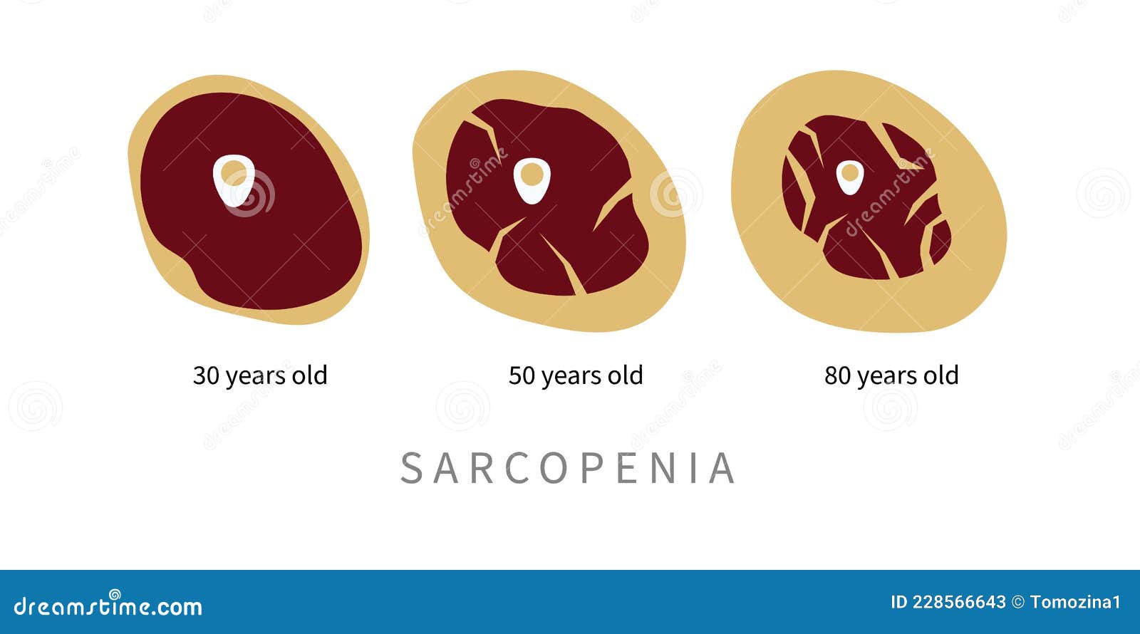 Sarcopenia As Muscle Mass Loss And Fatty Tissue Growth Outline Diagram ...