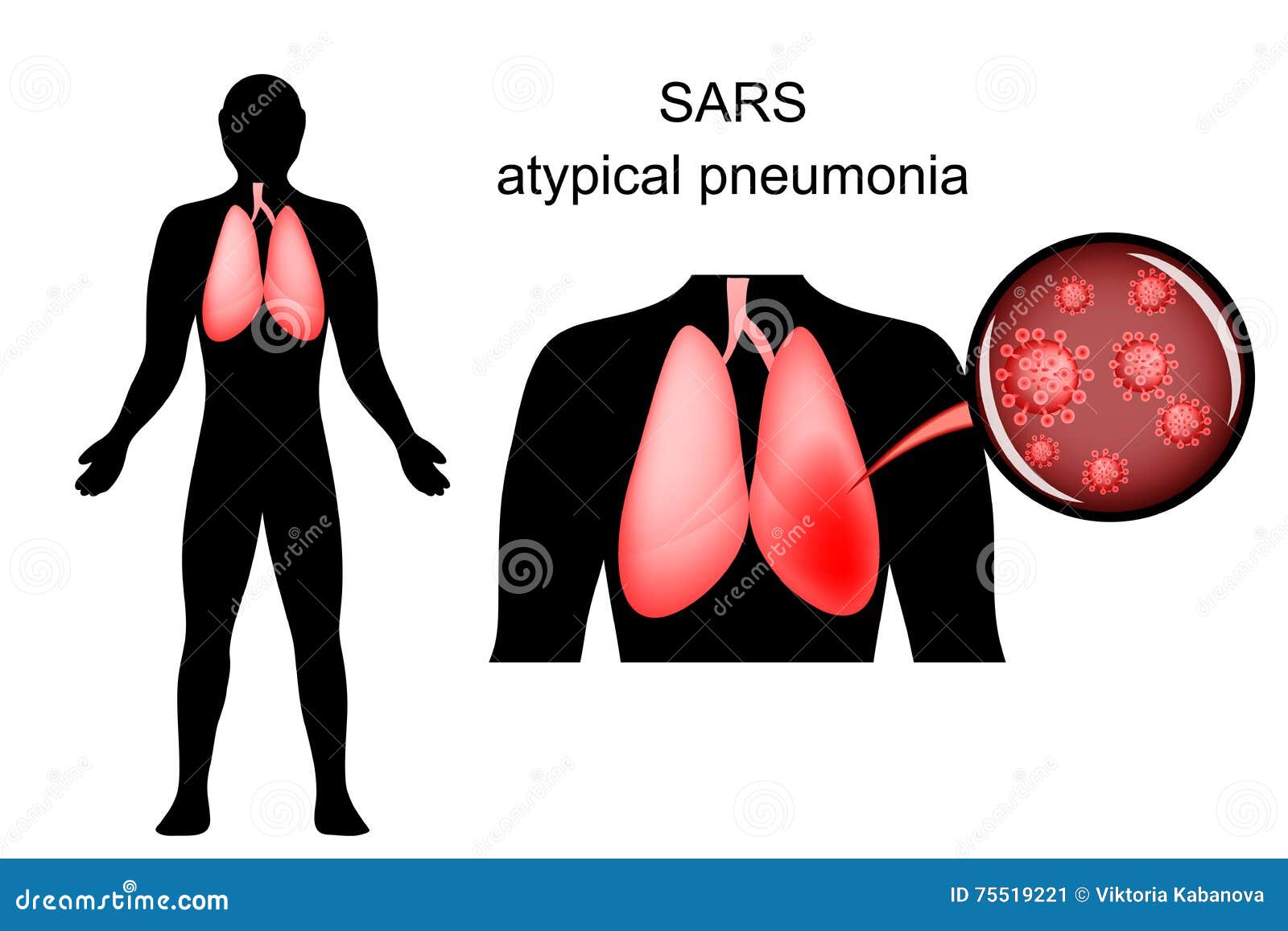 SARS. Inflamed Lungs and the Causative Agent Stock Vector ...