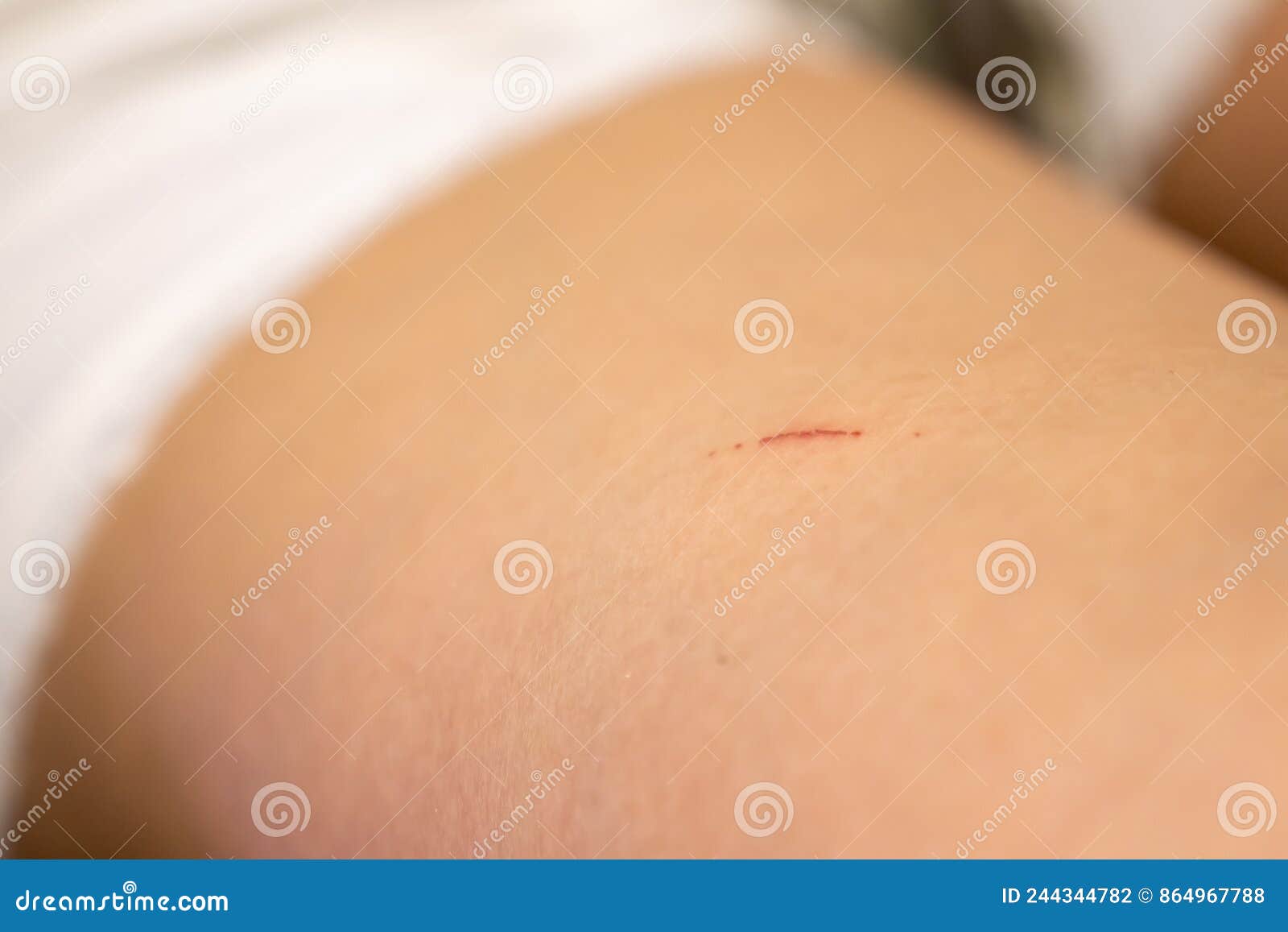 A Bleeding Wound on a Broken Skin Stock Photo - Image of human ...