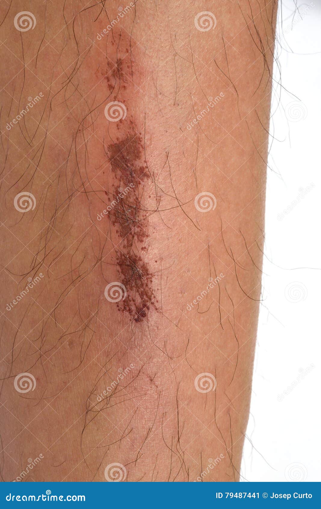 Scab leg stock image. Image of health, injury, scab, accident - 79487441
