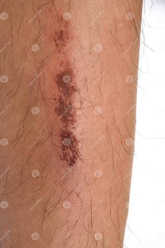 Scab leg stock image. Image of health, injury, scab, accident - 79487441