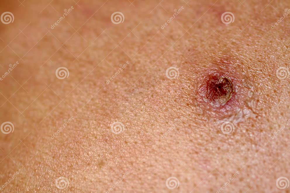Scab on the Skin. a Wound on the Skin. Stock Photo - Image of bleeding ...