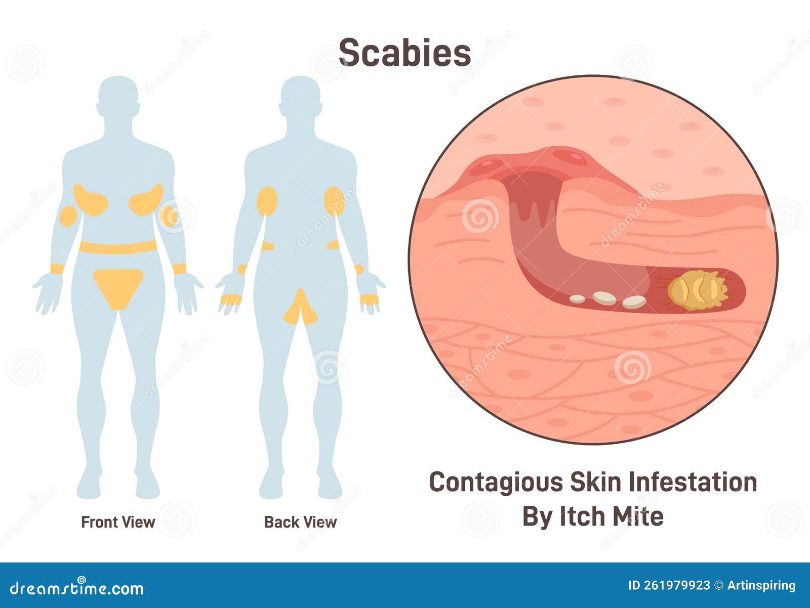 Scabies Mite Bites On Humans